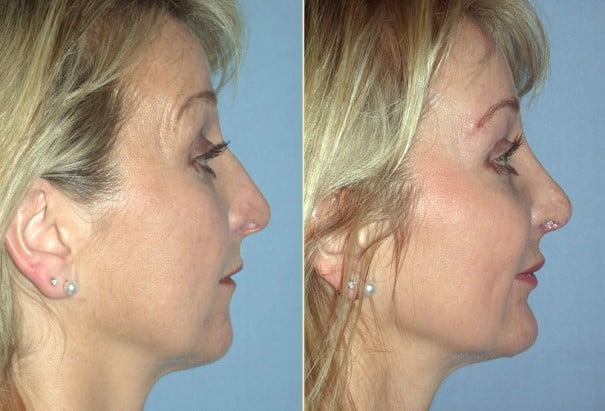 Chin Implant Surgery - Eugene, OR - Dr. Movassaghi
