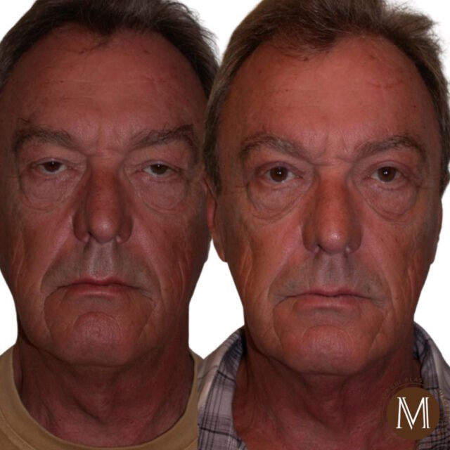 Eyelid Surgery for Men - Eugene, OR - Browlift for Men - Dr. Movassaghi